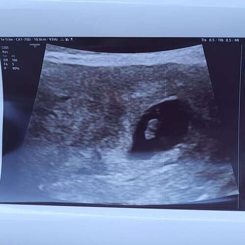 Wat zegt de ligging van het vruchtje? | babypraat | 1 | 24baby Forum