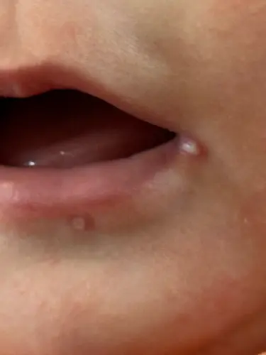 Bultjes rond mond | gezondheid | 1 | 24baby Forum