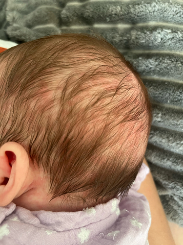 Eerst verhoging daarna rode vlekjes | gezondheid | 1 | 24baby Forum