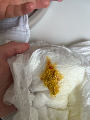 Beetje bloed ontlasting? Met foto! | 1 | 24baby Forum