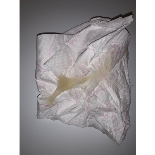 Slijmprop (Let op: foto) | bevalling | 1 | 24Baby Forum