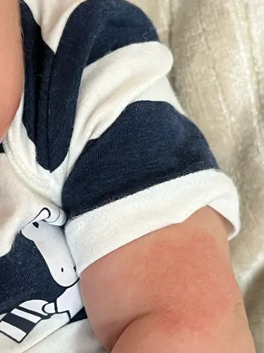 Rode plekjes? Wat is het zie foto! | 1 | 24baby Forum