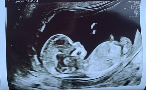 13 weken echo 🥹 | 1 | 24baby Forum