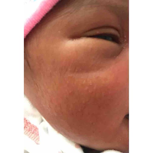 Kleine rode puistjes | 1 | 24baby Forum