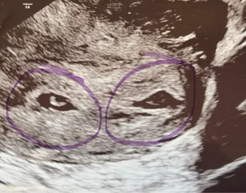 5 weken echo tweeling? | zwangerschapspraat | 1 | 24baby Forum