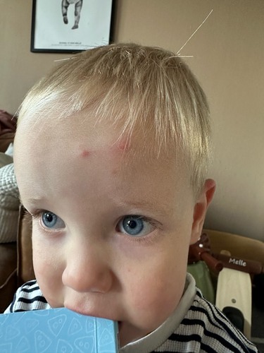 Waterpokken? | 1 | 24baby Forum