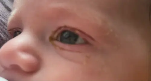 Baby snel hele vieze oogjes gezondheid | 1 | 24baby Forum