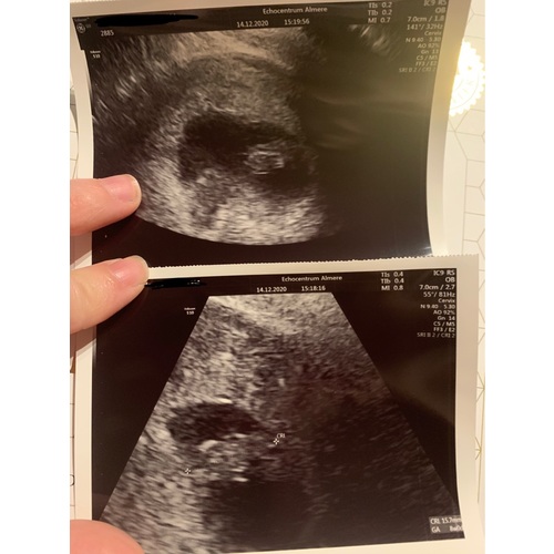 Goeie echo na miskraam | 1 | 24baby Forum