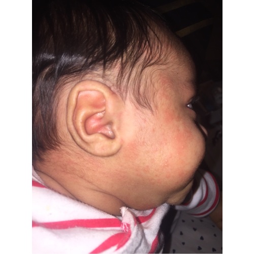 Pasgeboren 6 weken rode uitslag(bultjes) | 1 | 24baby Forum