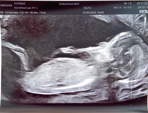 13 weken echo gehad. Geslacht? | 1 | 24baby Forum