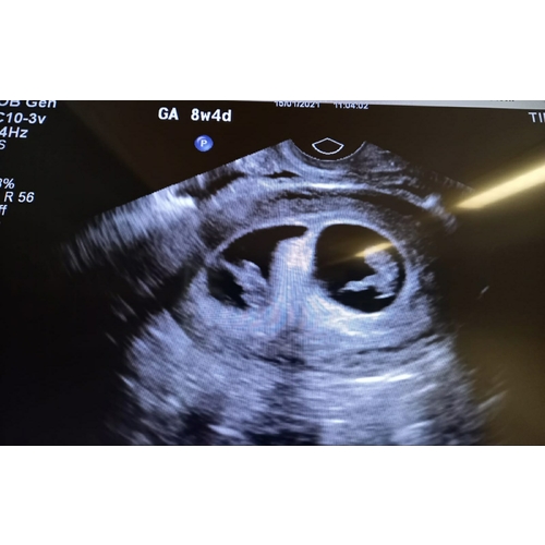 Verbaast 1ste echo | 1 | 24baby Forum