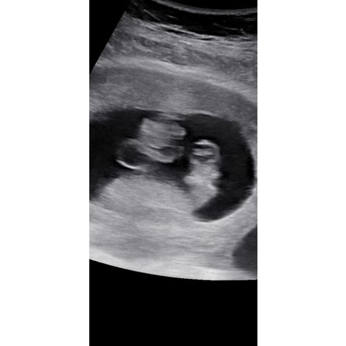 2e echo een tweeling | zwangerschapspraat | 1 | 24baby Forum