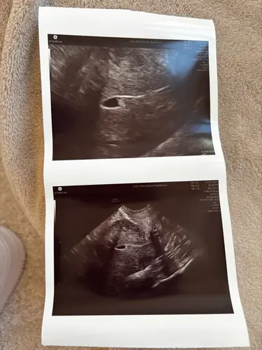 2e Miskraam | 1 | 24baby Forum