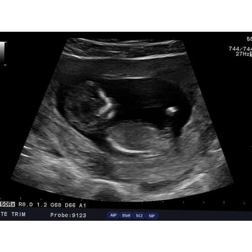 Ligging placenta | gezondheid | 1 | 24baby Forum