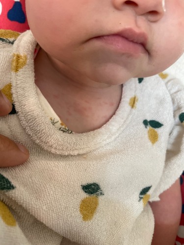 Is dit warmte uitslag? | 1 | 24baby Forum