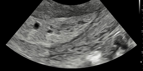 Wordt dit een miskraam? (Met echo) miskraam | 1 | 24baby Forum