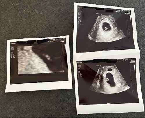 Miskraam of toch niet? overig | 1 | 24baby Forum